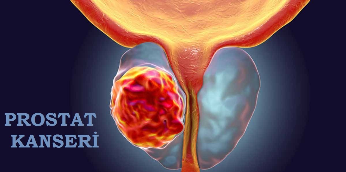 PROSTAT KANSERİ - Laparoskopik Radikal Prostatektomi - Prof. Dr. FARUK ...